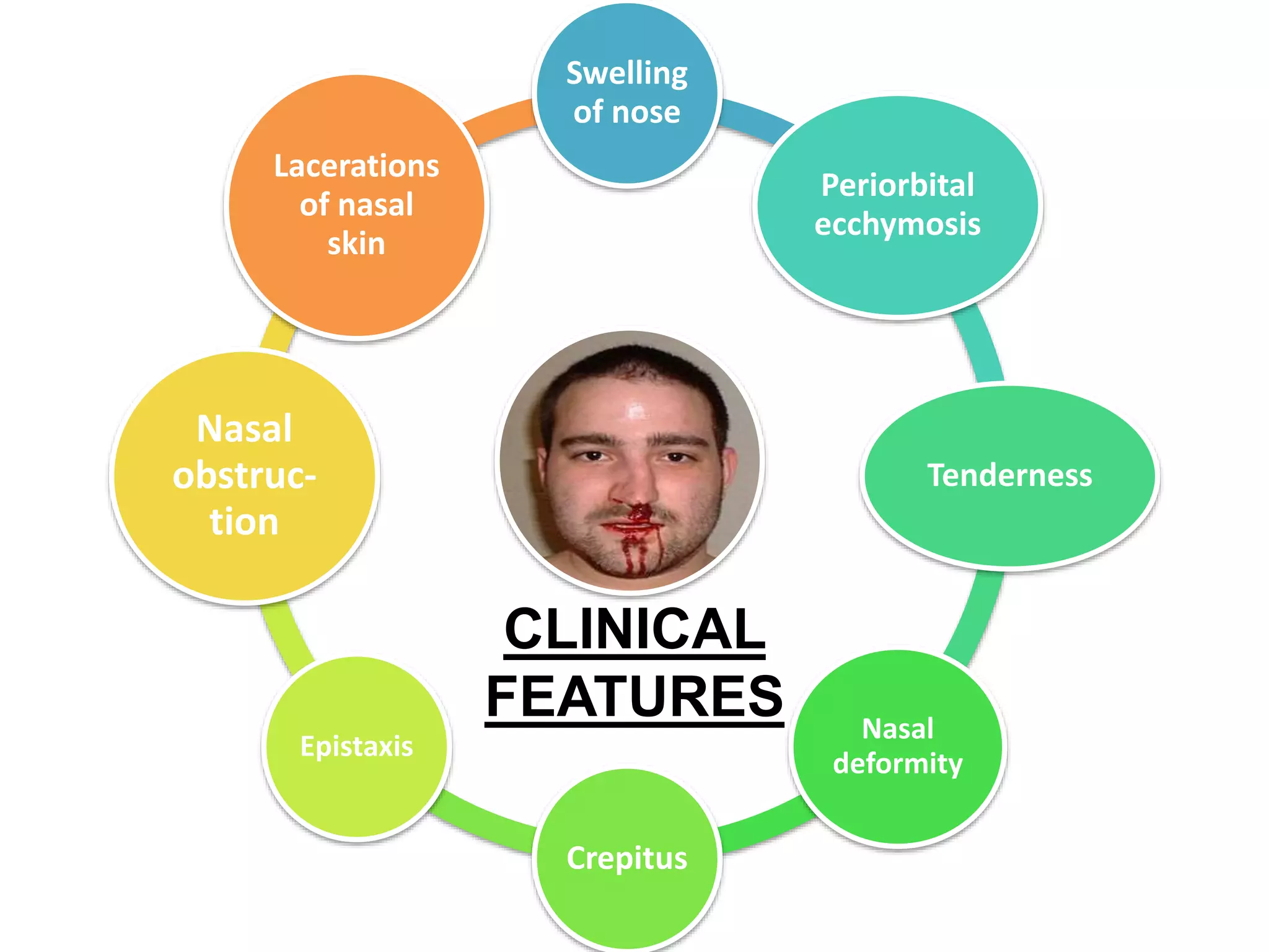 NASAL BONE FRACTURE | PPTX