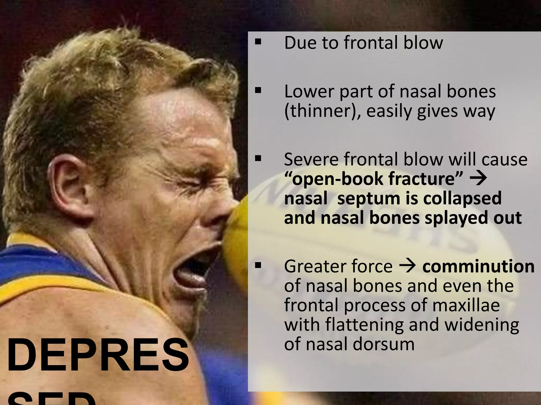 NASAL BONE FRACTURE | PPTX