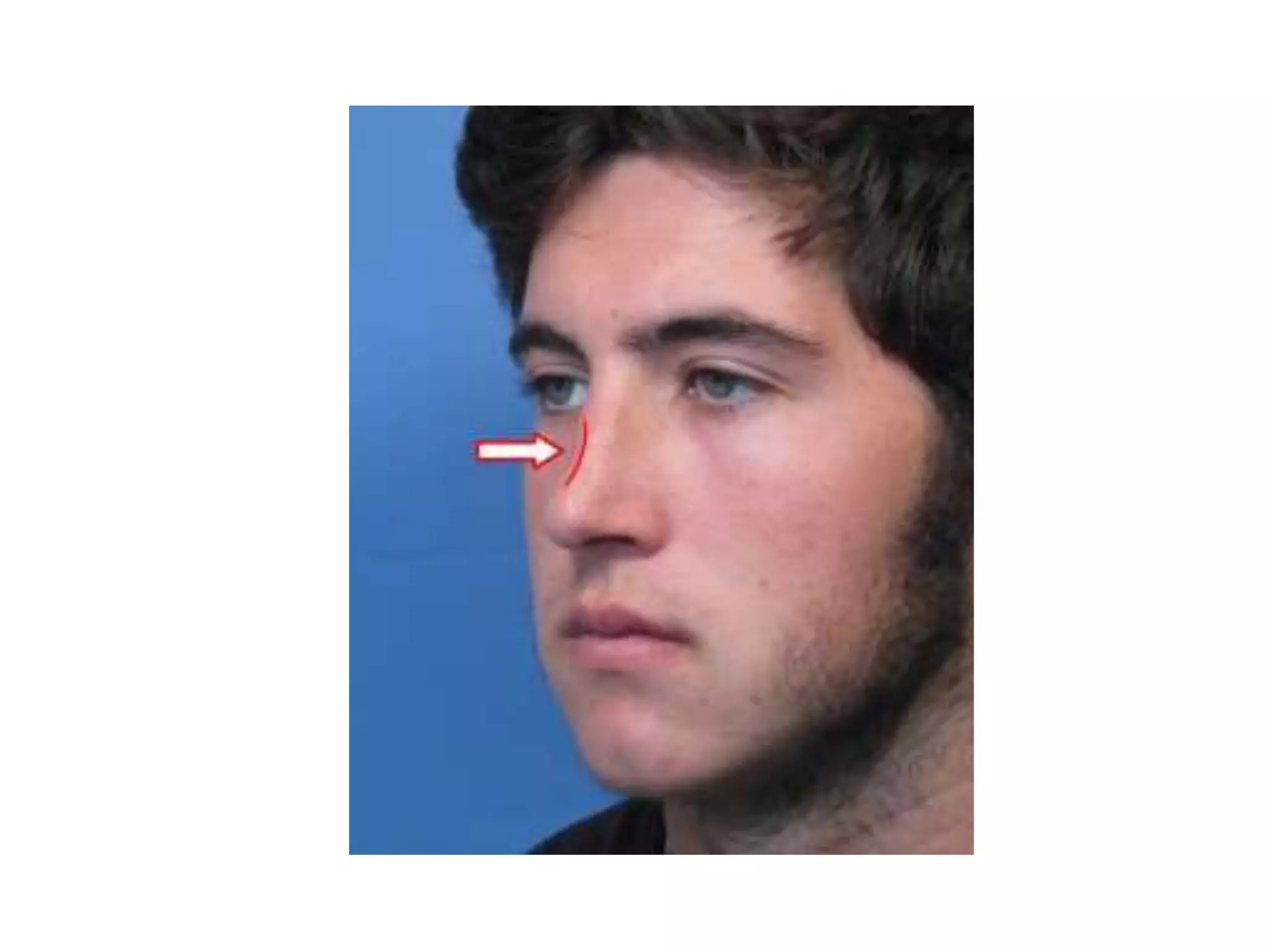 Nasal Bone Fracture Pptx