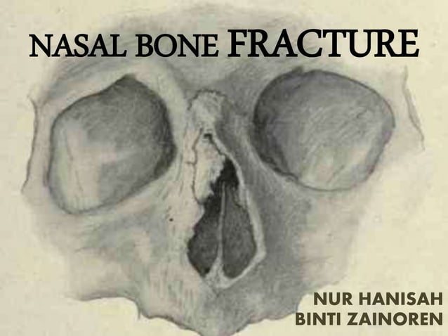 Nasal Bone Fracture Ppt