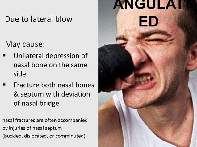 Nasal Bone Fracture Pptx