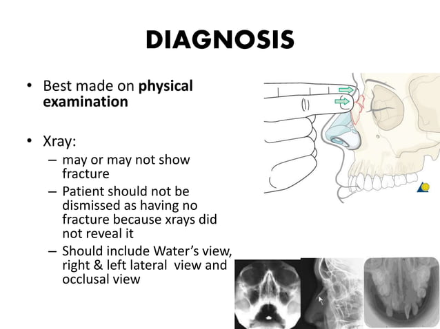 Nasal Bone Fracture Ppt