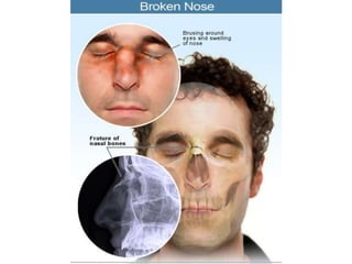X Ray Broken Nose