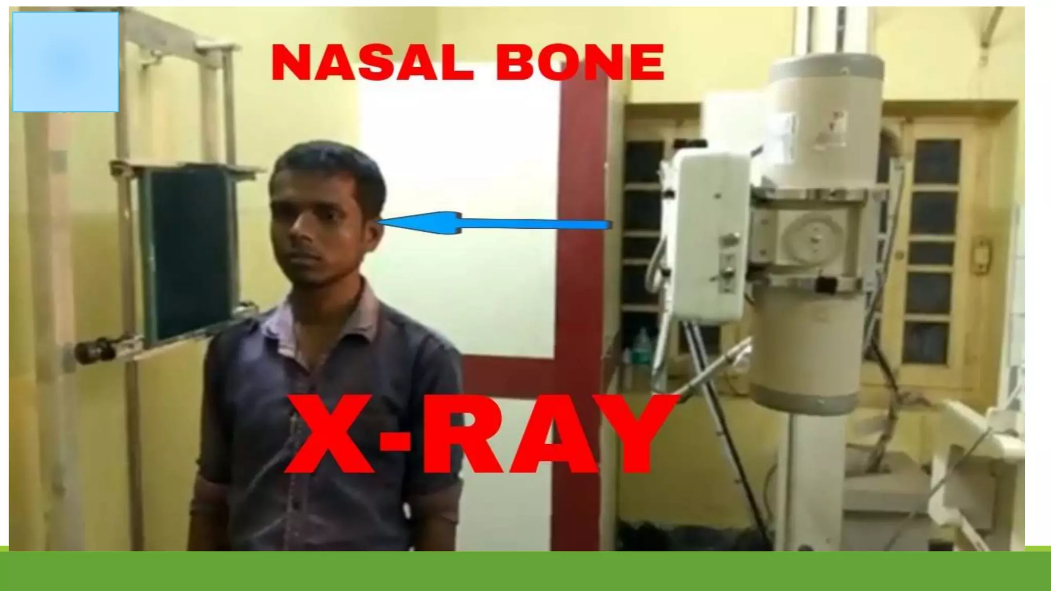 NASAL BONE VIEW.pptx