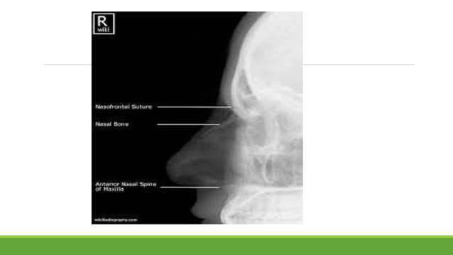 NASAL BONE VIEW.pptx | Bone and Joint Conditions | Diseases and Conditions