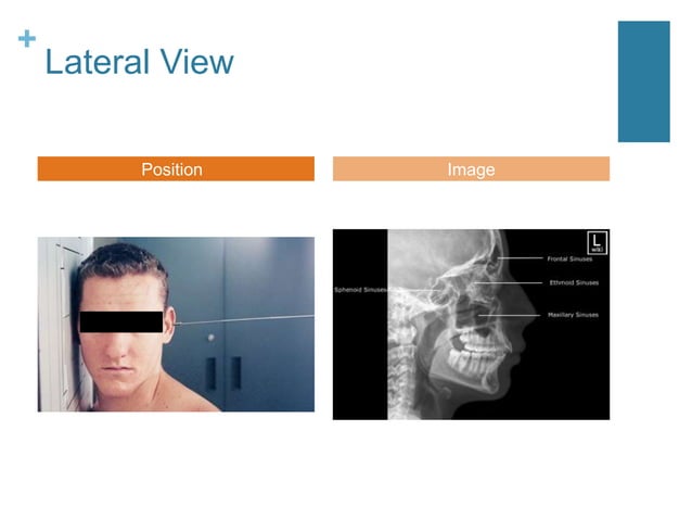 Nasal cavity and paranasal sinuses radiologic anatomy | PPTX