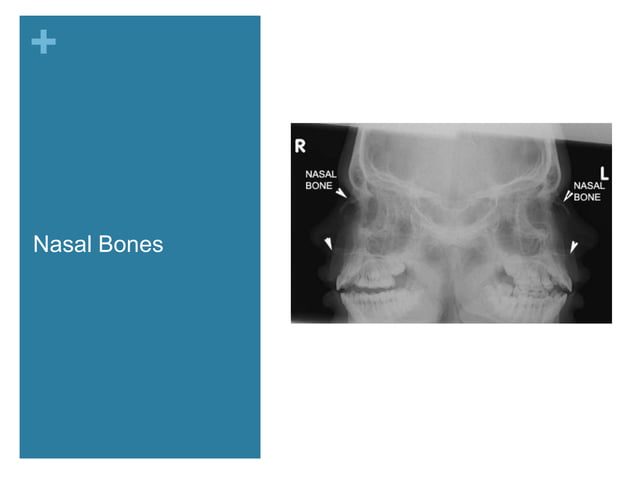 Nasal cavity and paranasal sinuses radiologic anatomy | PPTX