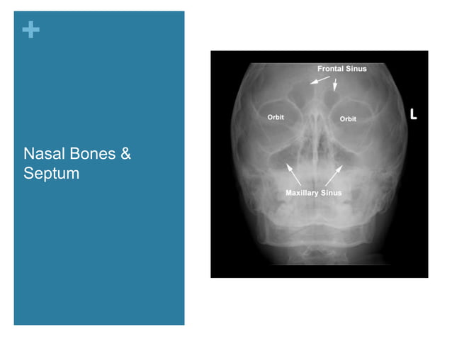 Nasal cavity and paranasal sinuses radiologic anatomy | PPTX