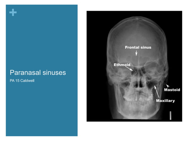 Nasal cavity and paranasal sinuses radiologic anatomy | PPTX