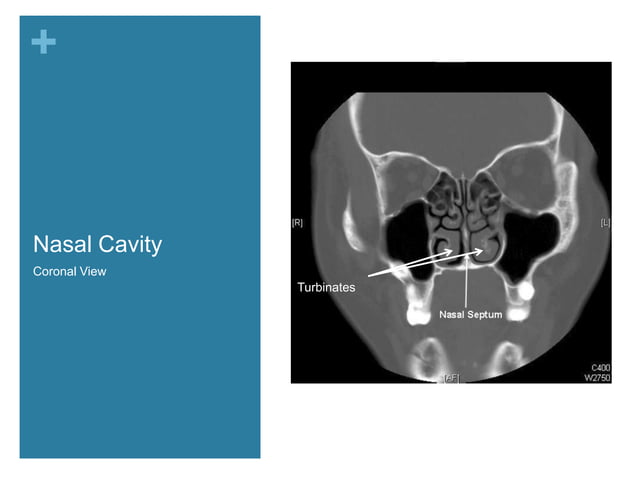 Nasal cavity and paranasal sinuses radiologic anatomy | PPTX