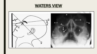 Nasal cavity and paranasal sinuses | PPTX