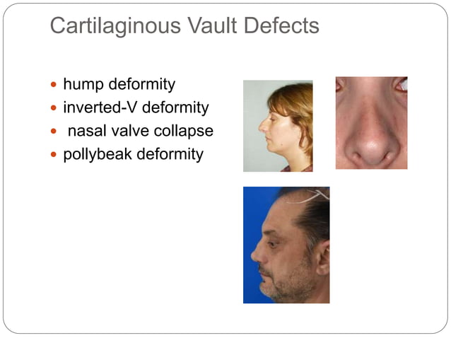 Nasal dorsum 2023.pptx