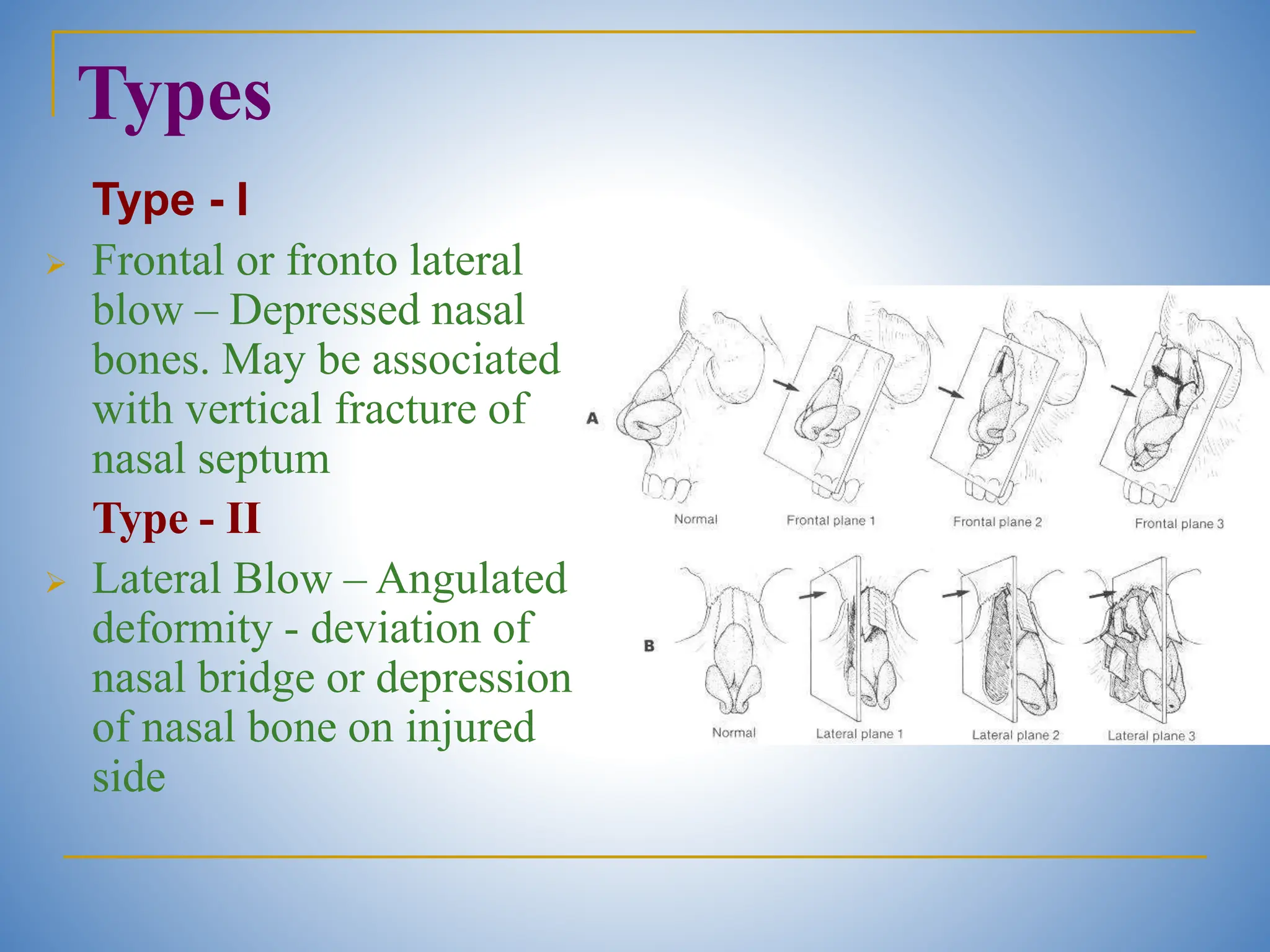 Nasal and Facial fracture ( under graduate) | PPTX
