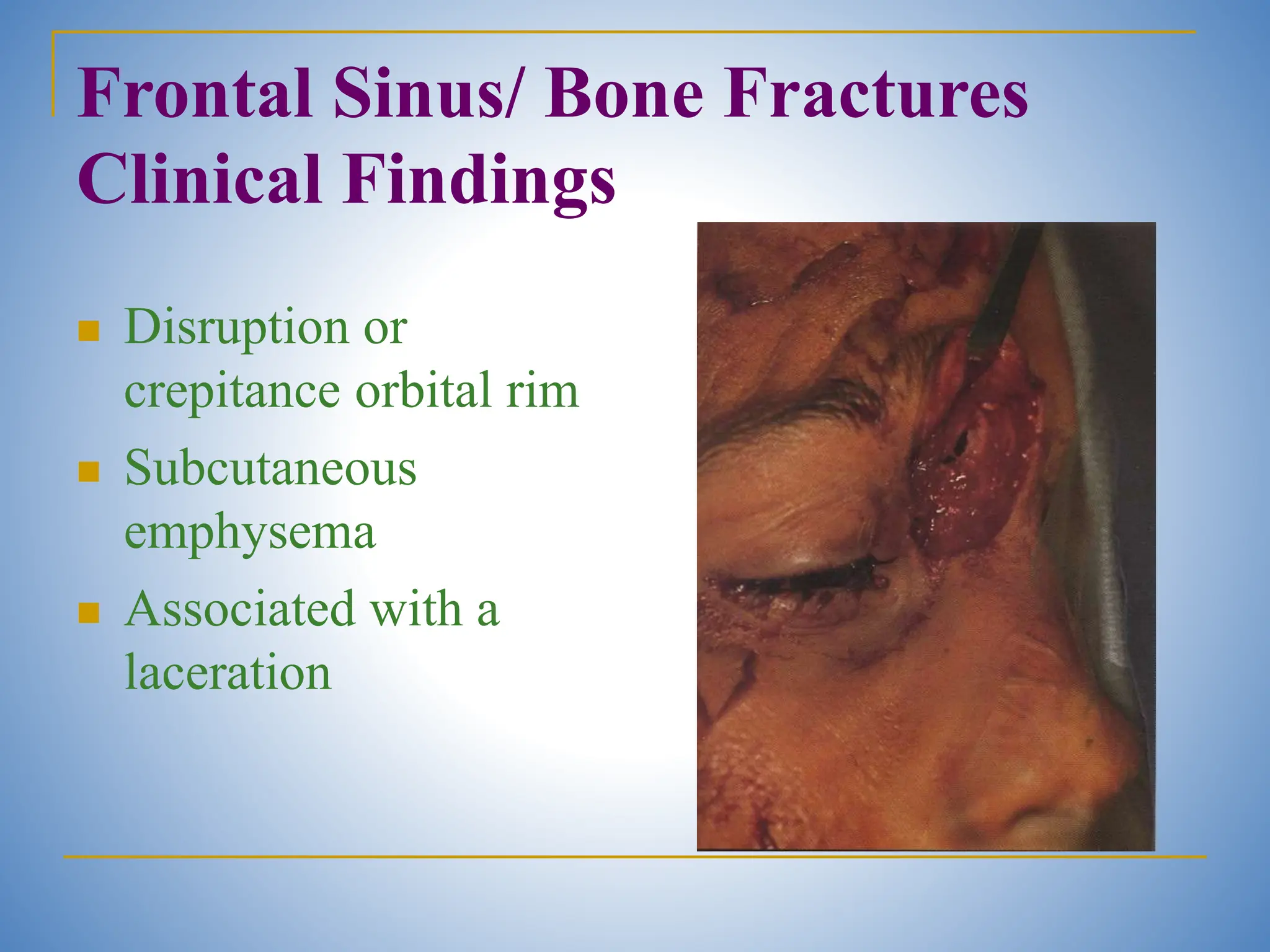 Nasal and Facial fracture ( under graduate) | PPTX