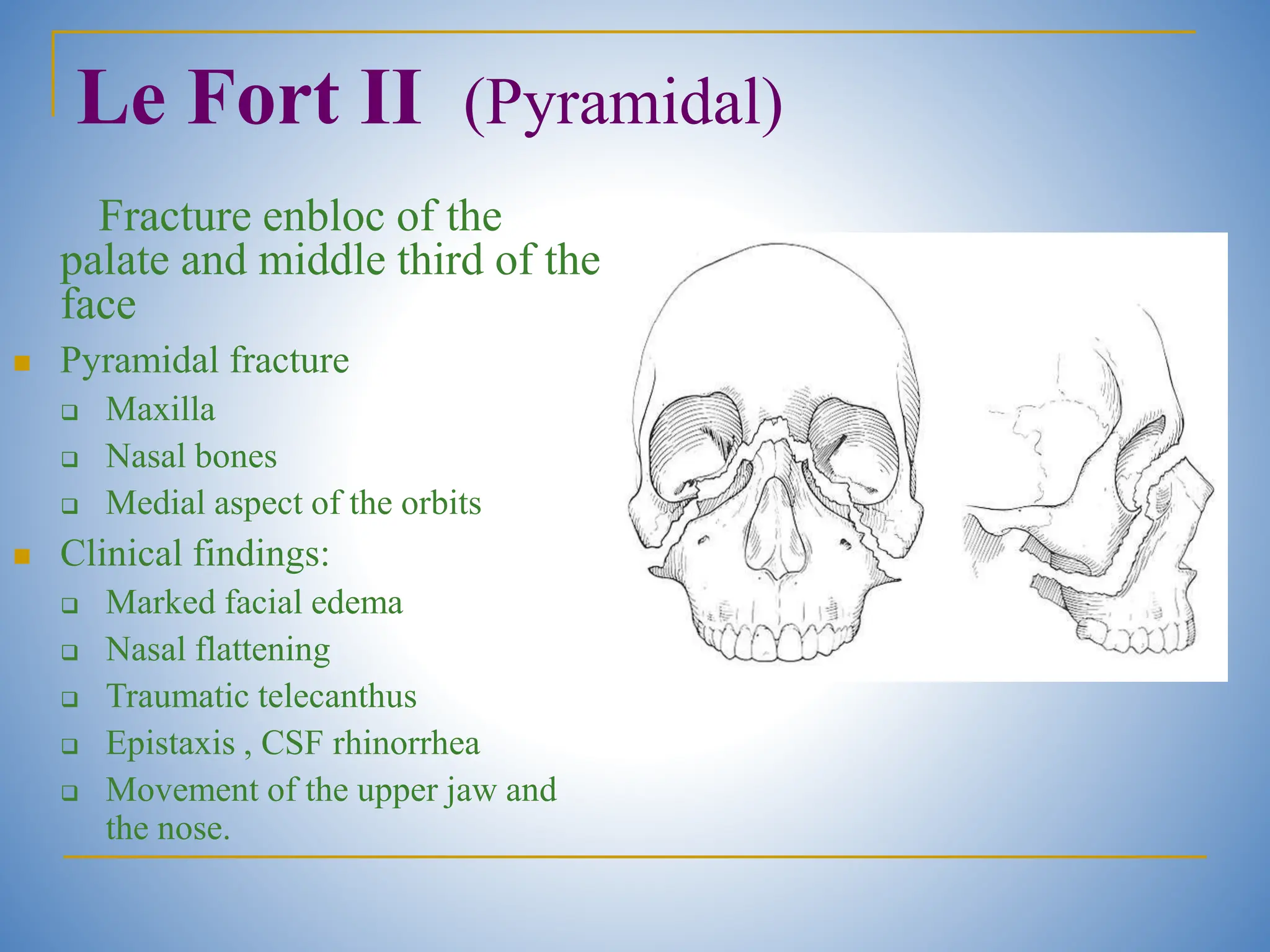 Nasal and Facial fracture ( under graduate) | PPTX