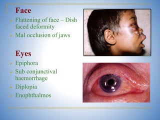 Nasal and Facial fracture ( under graduate) | PPTX