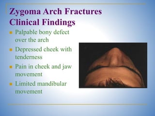 Nasal and Facial fracture ( under graduate) | PPTX