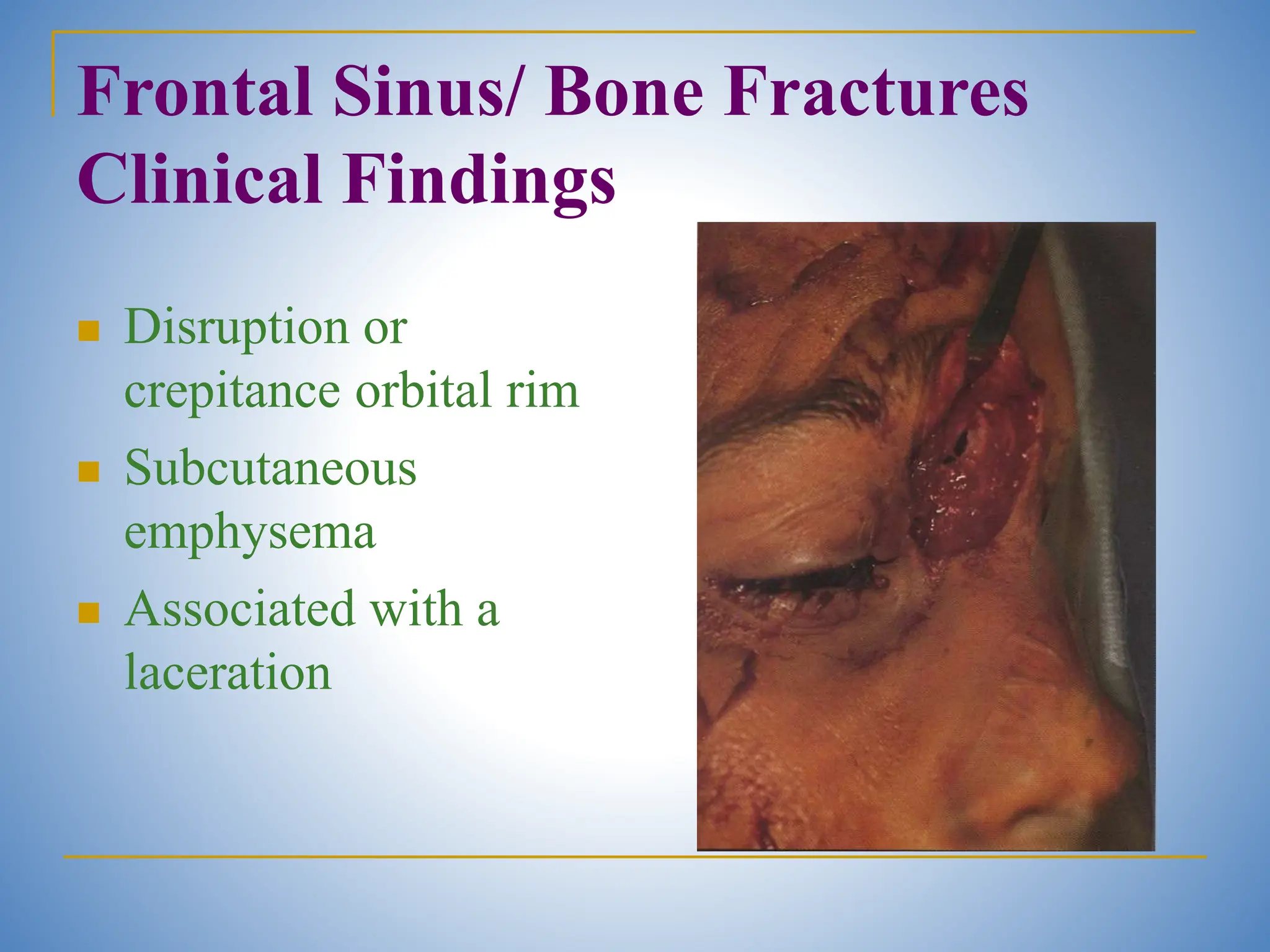 Nasal & Facial Injuries ug.............. | PPTX