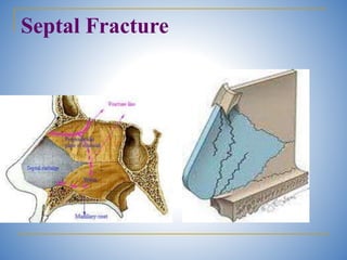 Nasal & Facial Injuries ug.............. | PPTX
