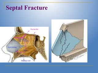 Nasal & Facial Injuries ug.............. | PPTX