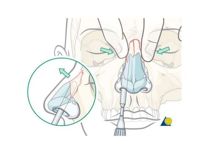 Nasal fracture revised | PPTX | First Aid | Injuries