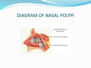 Nasal polyp | PPTX
