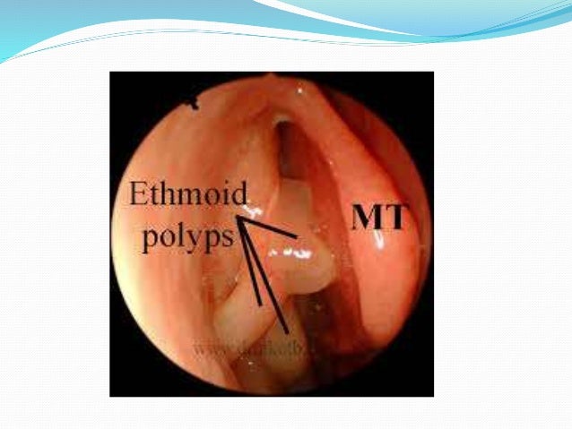 Nasal Polyp