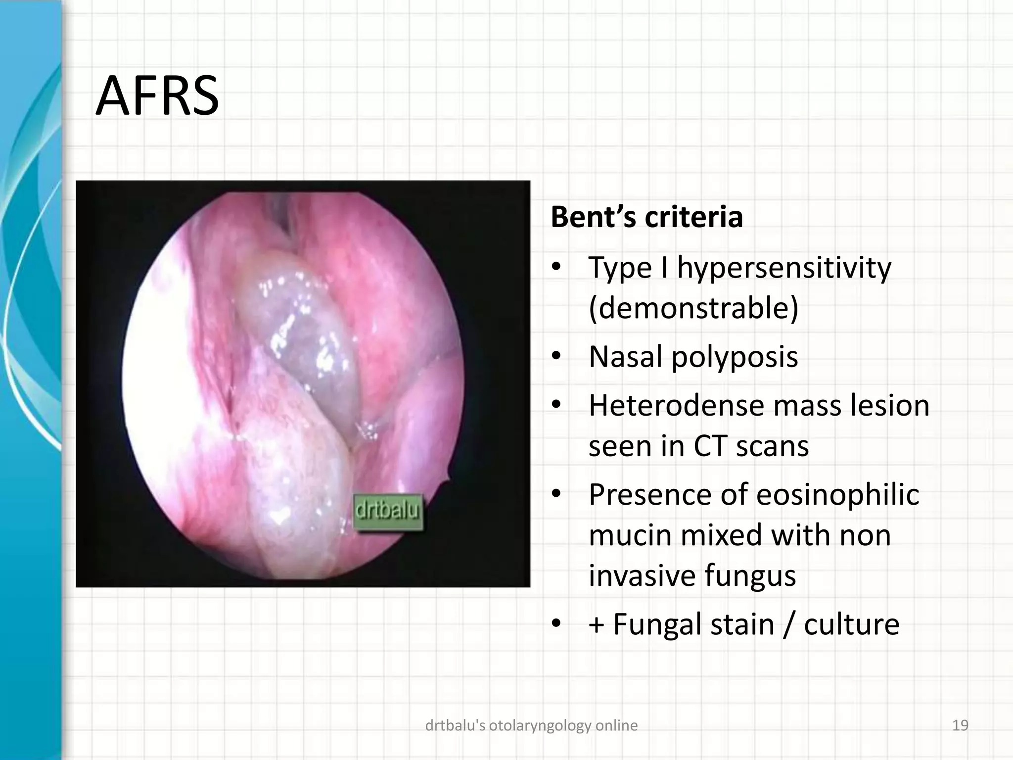 NASAL POLYP | PDF