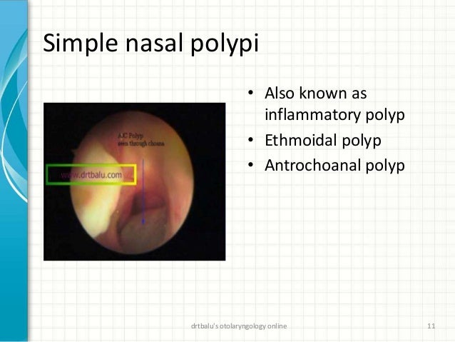 NASAL POLYP