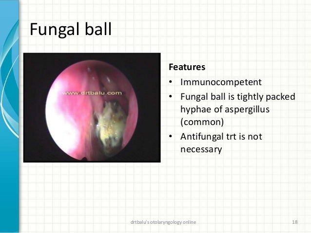 NASAL POLYP