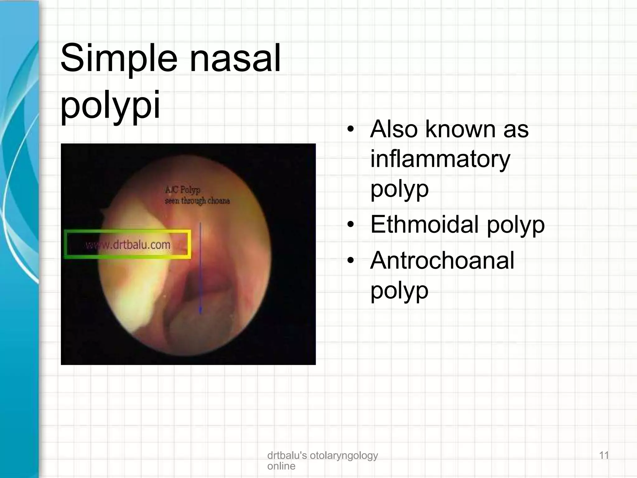Nasal Polyps: etiology,pathogenesis,clinical features,management | PPTX