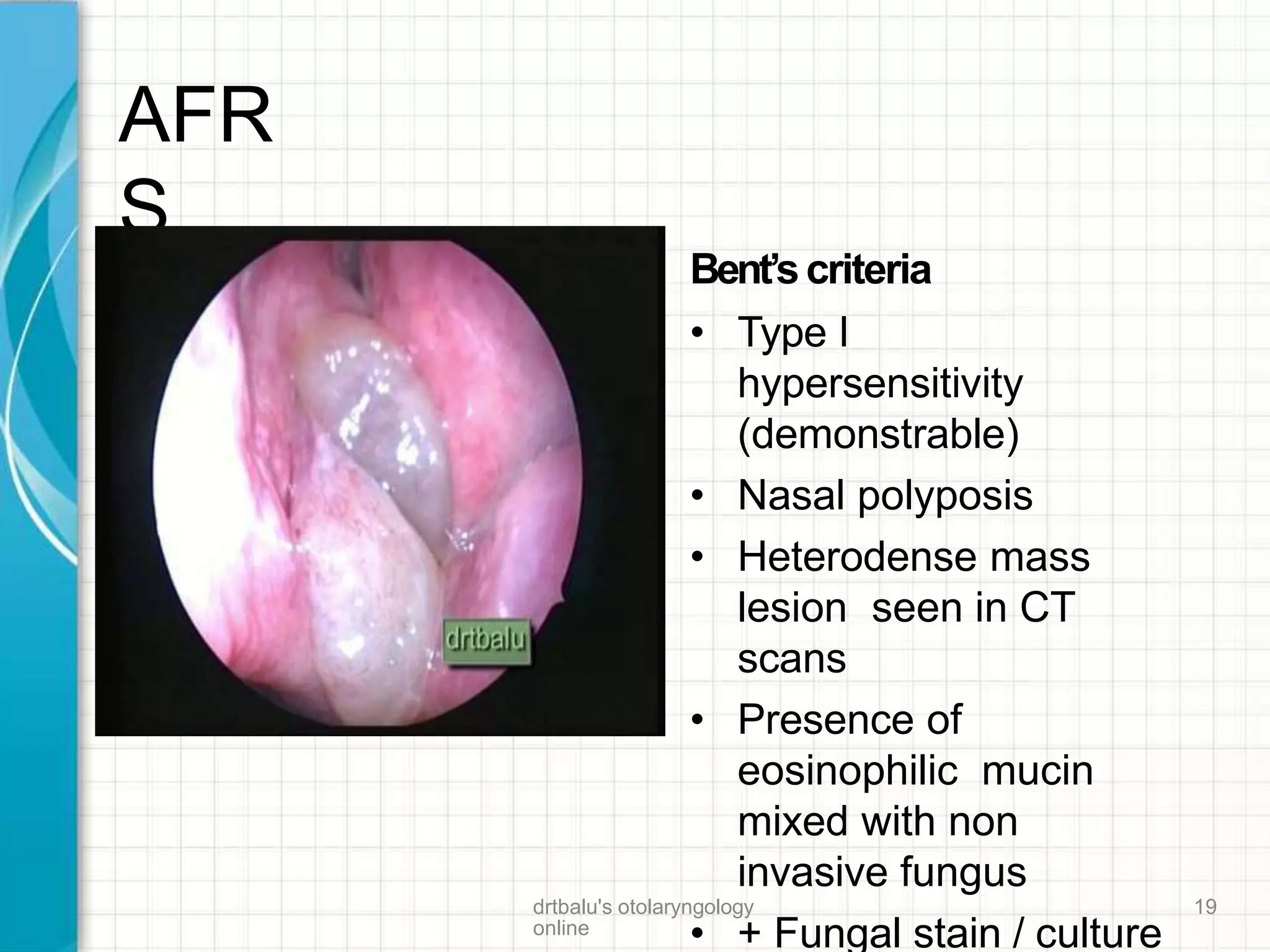 Nasal Polyps: etiology,pathogenesis,clinical features,management | PPTX ...