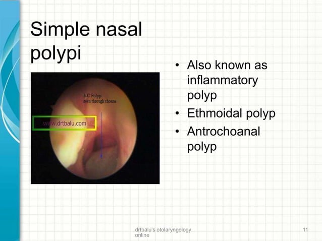 Nasal Polyps: etiology,pathogenesis,clinical features,management
