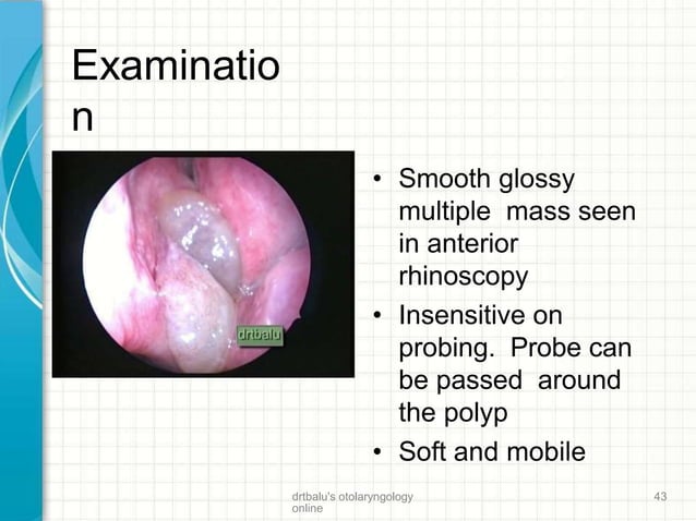 Nasal Polyps: etiology,pathogenesis,clinical features,management