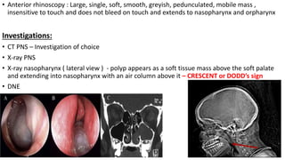 Nasal polyp | PPTX | Ear, Nose and Throat Conditions | Diseases and ...