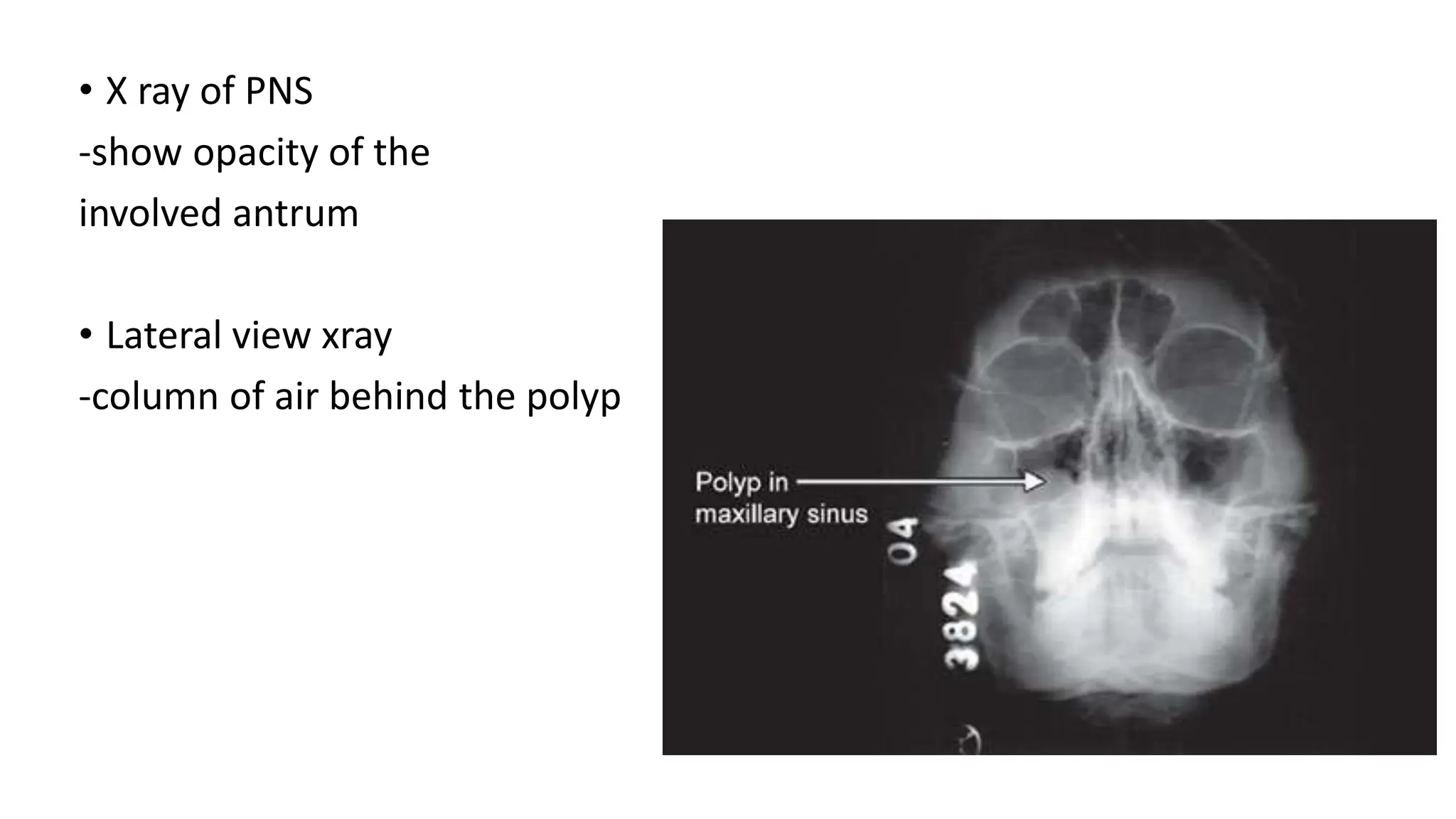 Nasal polyp antrochoanal polyp ethmoid polyp | PPTX