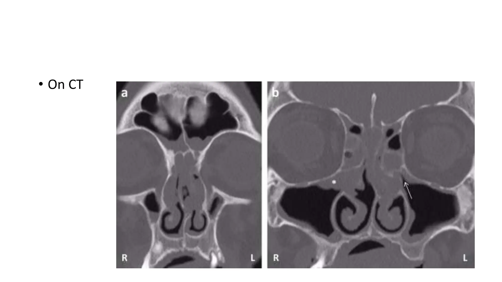 Nasal polyp antrochoanal polyp ethmoid polyp | PPTX