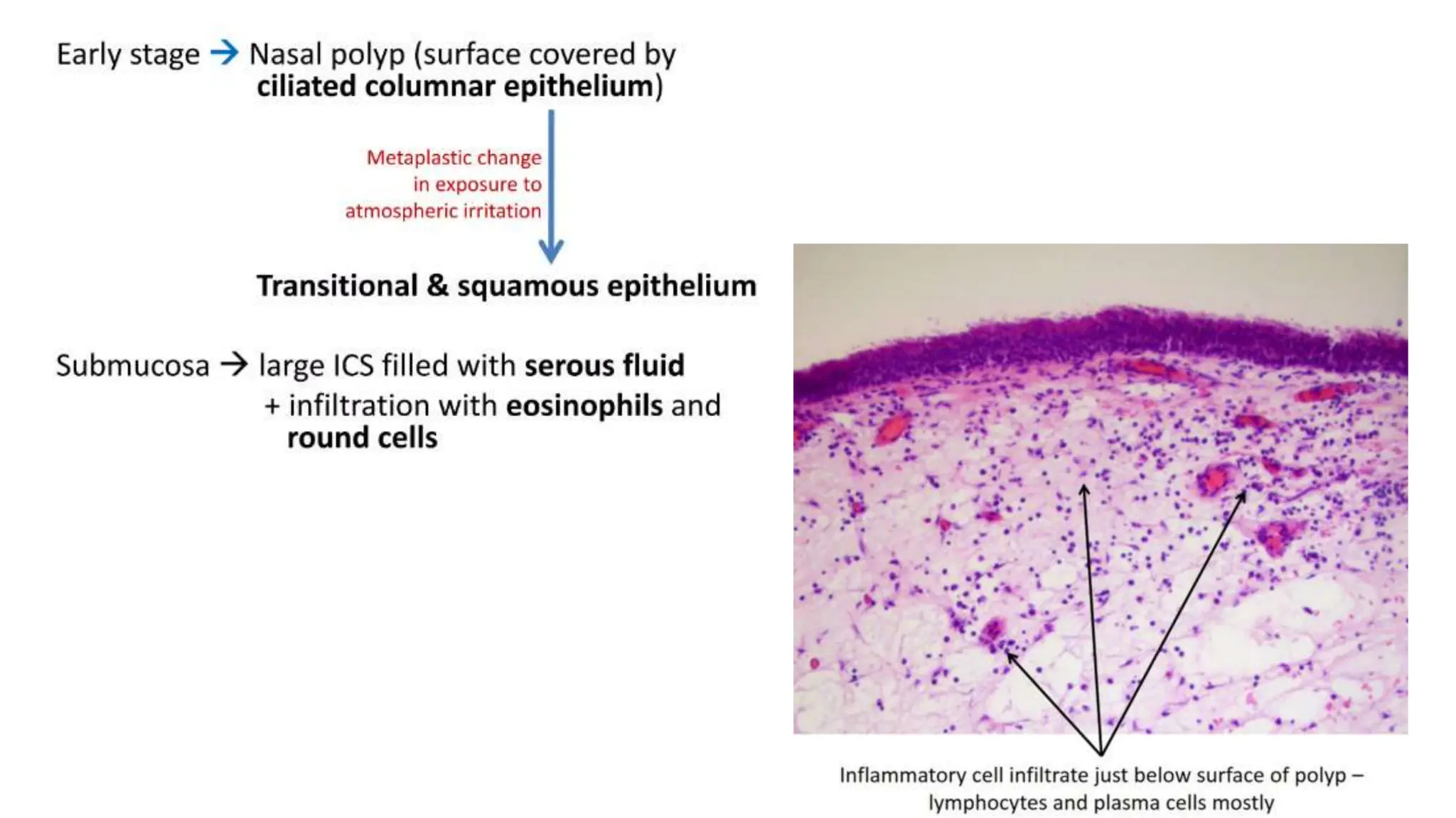 Nasal polyp antrochoanal polyp ethmoid polyp | PPTX