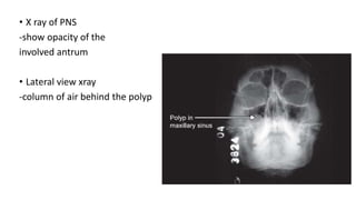 Nasal polyp antrochoanal polyp ethmoid polyp | PPTX
