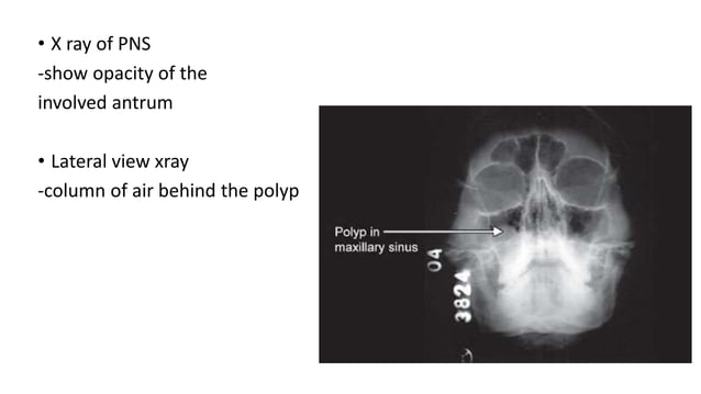 Nasal polyp antrochoanal polyp ethmoid polyp | PPTX