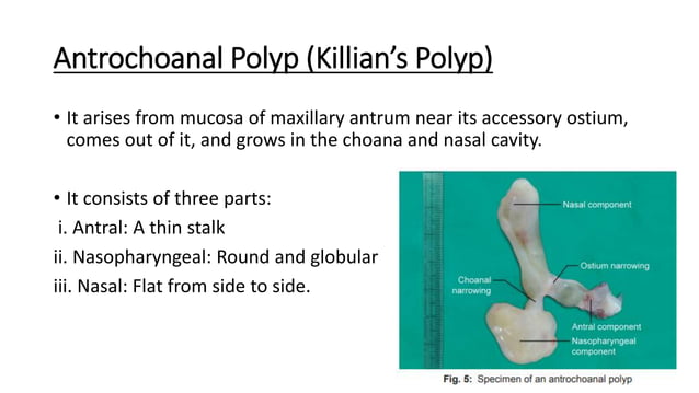 Nasal polyp antrochoanal polyp ethmoid polyp | PPTX