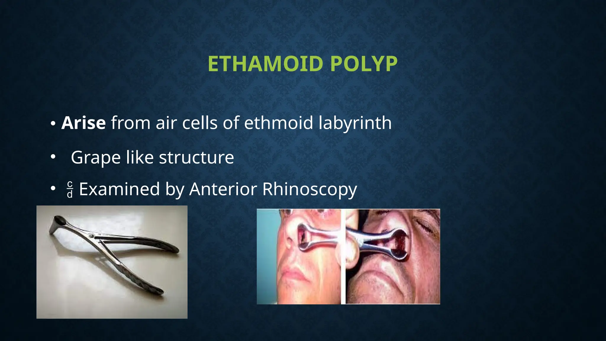 NASAL POLYP.pptx defintion ,cause treatment | PPTX