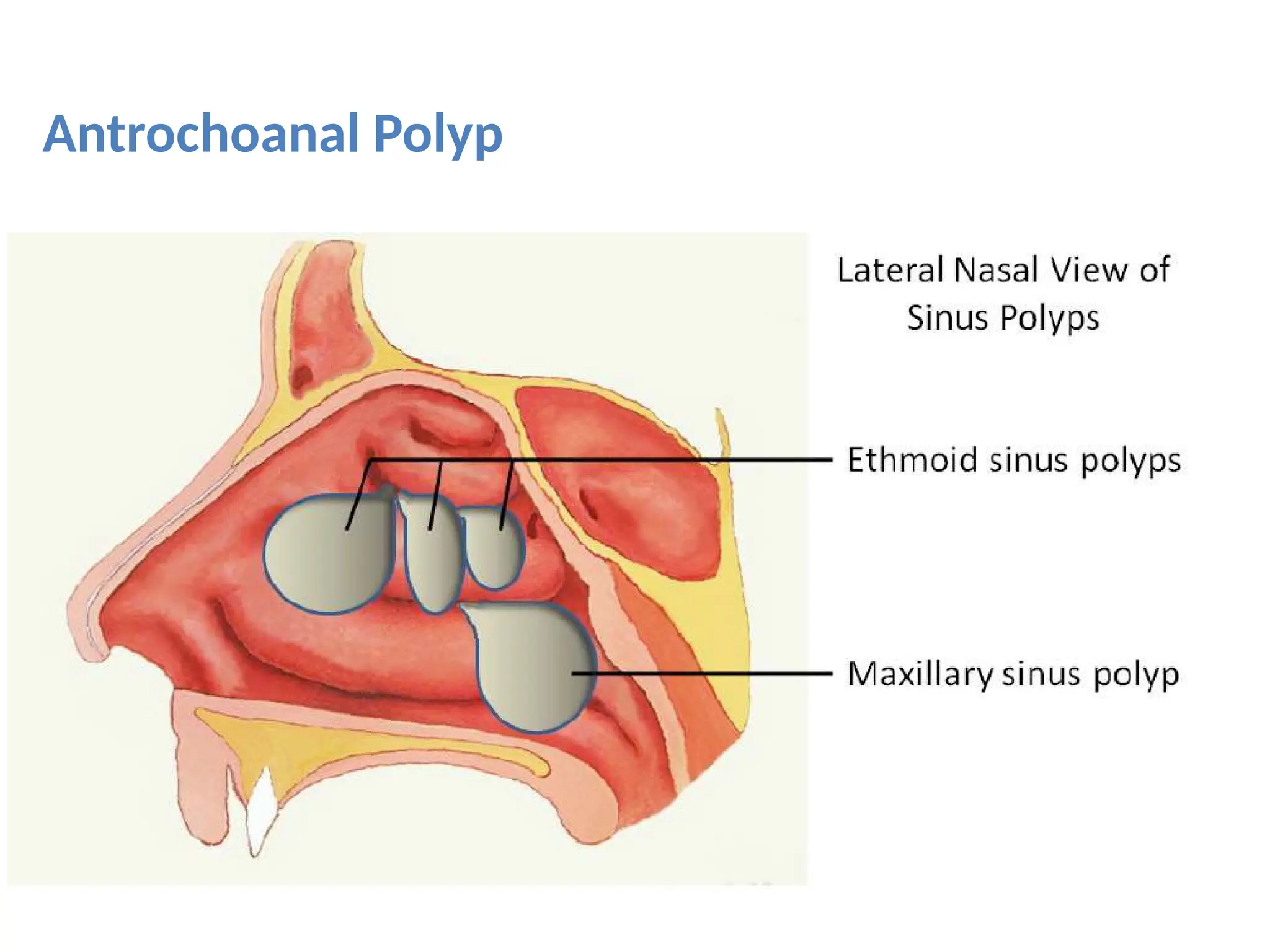 nasalpolypaedfawrstfgergdfbvcbergferf.pptx