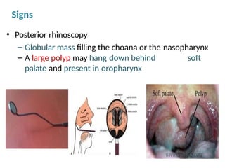 nasalpolypaedfawrstfgergdfbvcbergferf.pptx