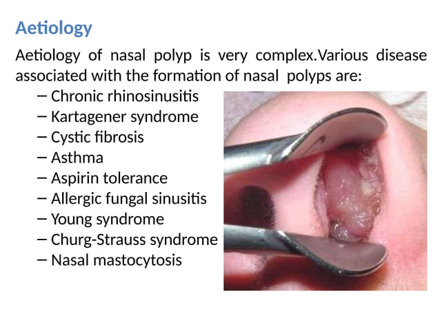 nasalpolypaedfawrstfgergdfbvcbergferf.pptx