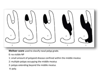 nasal polyp abu zneid.pptx