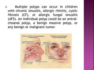 Nasal polyposis | PPTX | Ear, Nose and Throat Conditions | Diseases and ...
