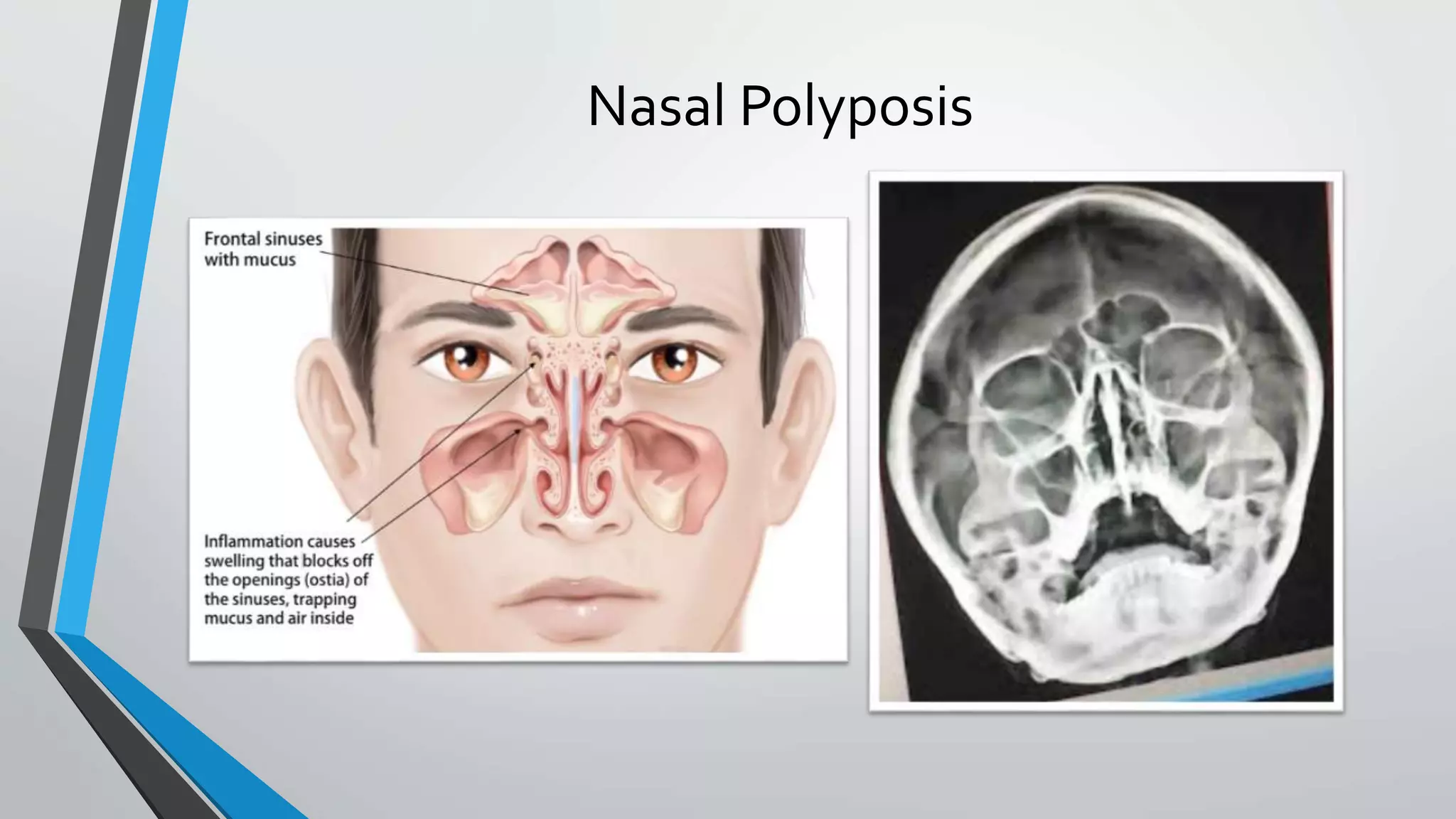 Nasal polyposis | PPTX