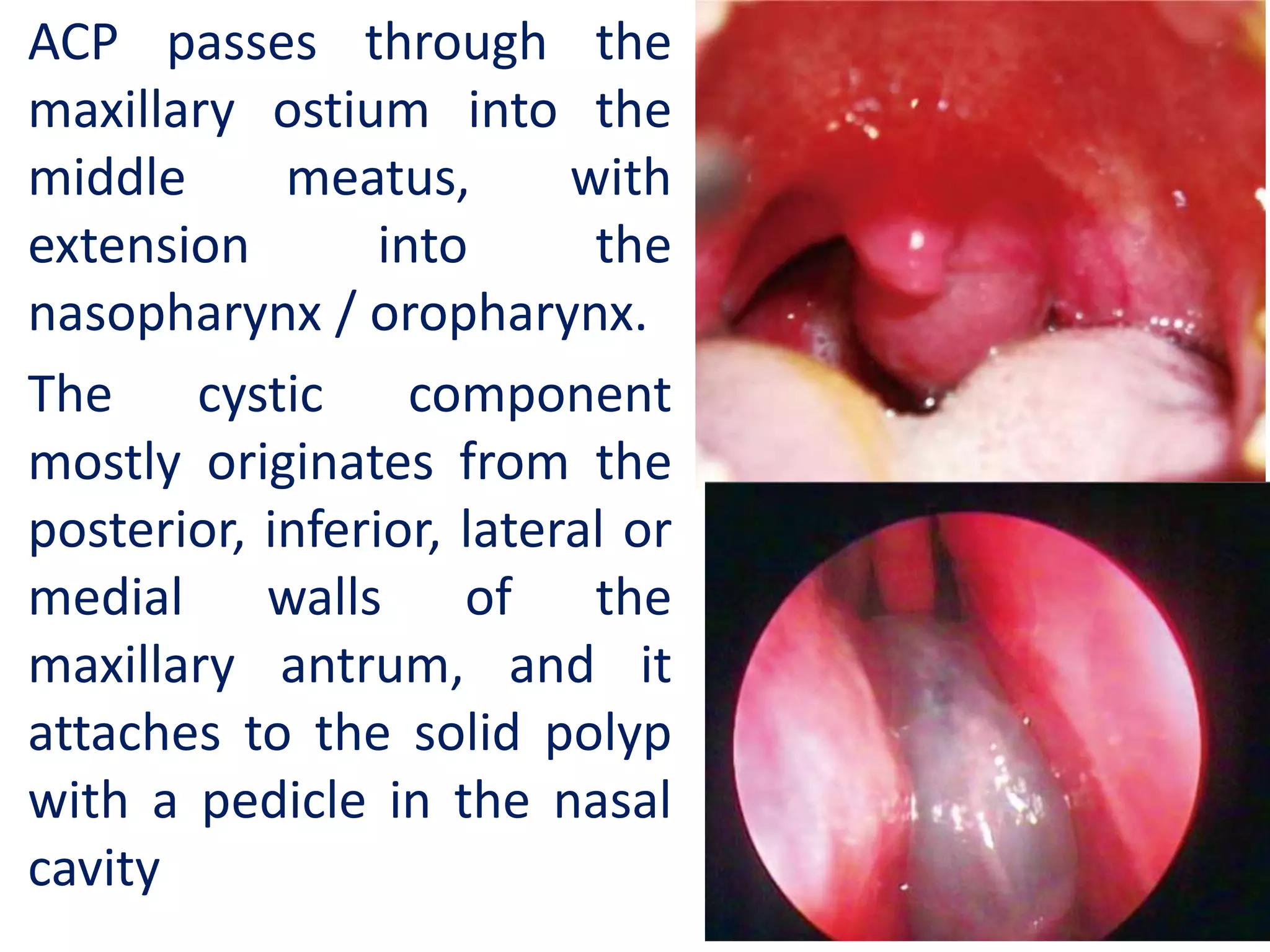 Nasal Polyposis.pptx