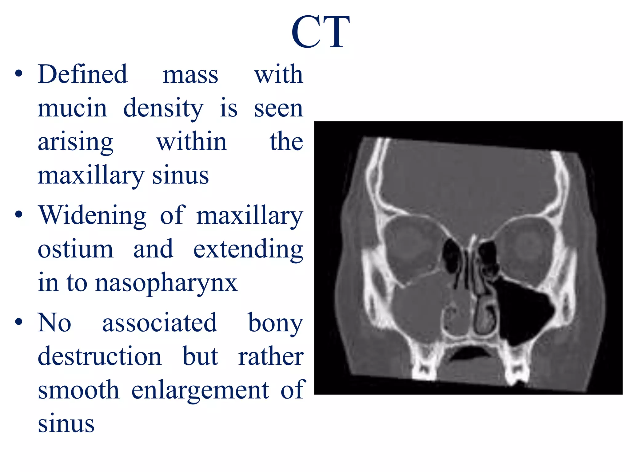 Nasal Polyposis.pptx